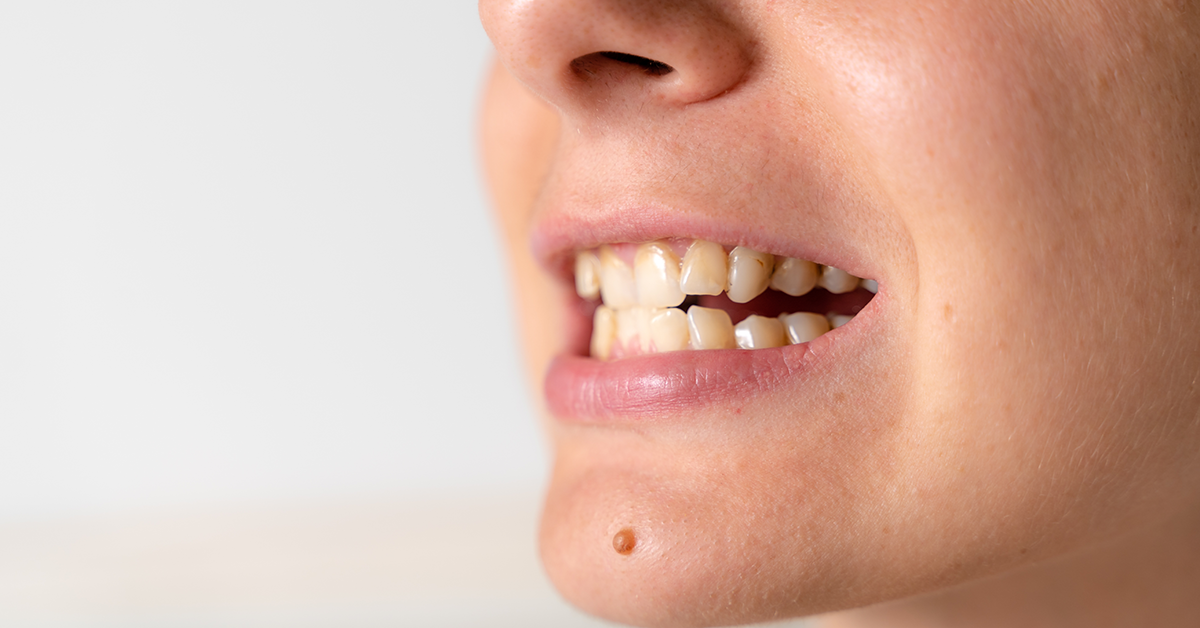 What is Malocclusion...and Should You Be Concerned?